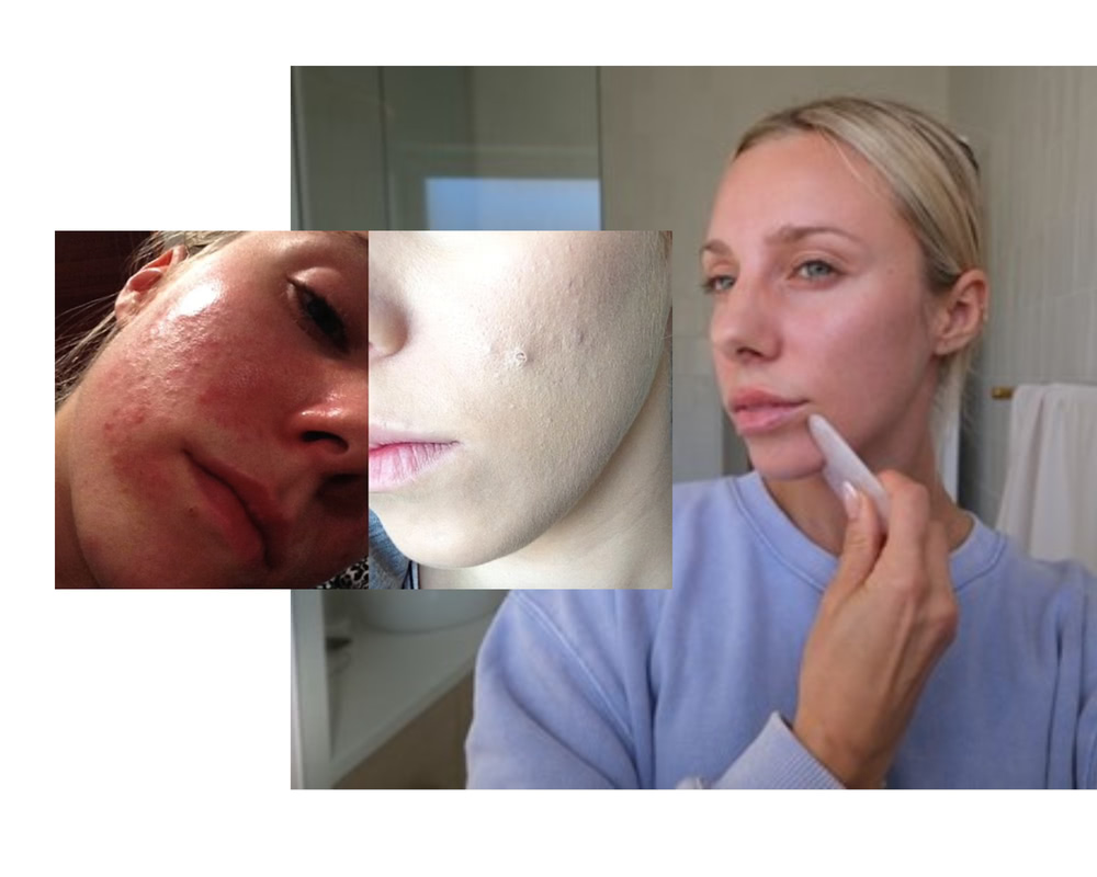 Hormonal Acne: Causes, Treatment Options & Prevention