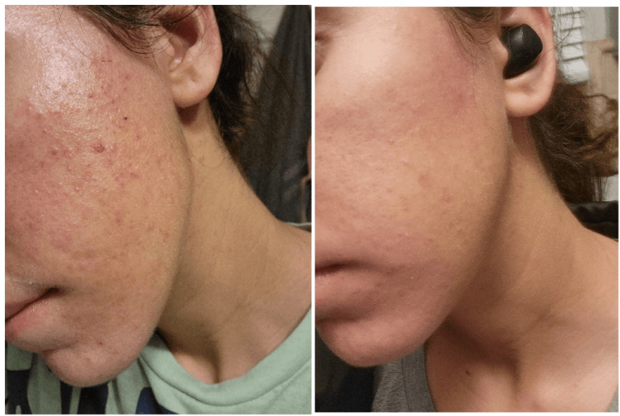 How to Know if My Pimples Are Hormone Caused or by Other Factors