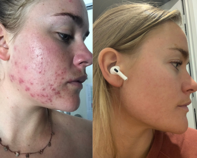 Best Vitamins for Hormonal Acne - Tips from a Qualified Naturopath